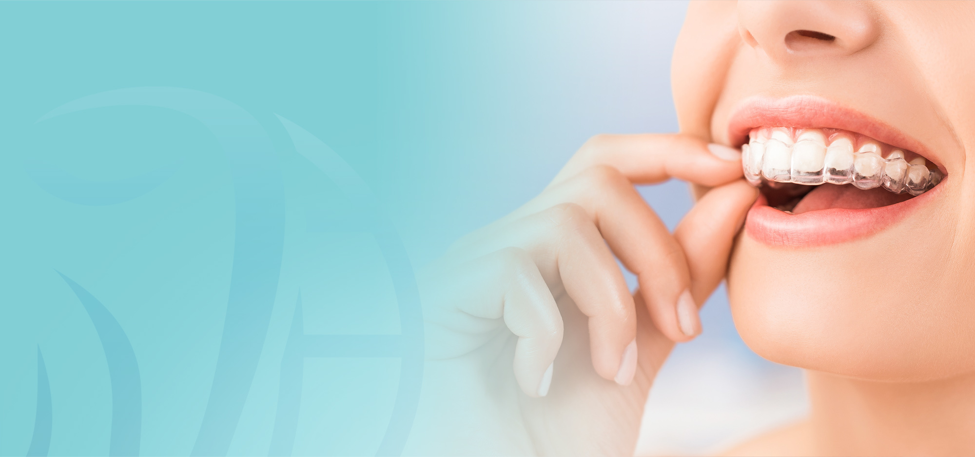 Veneers Glen Innes - Invisalign Clear Aligners Glendowie